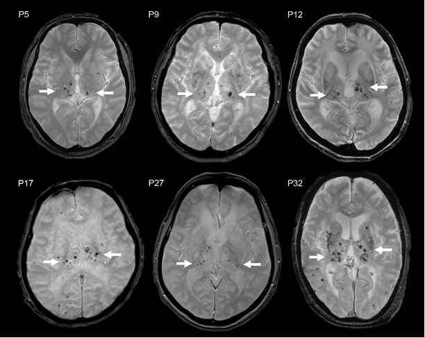 CADASILの原因遺伝子であるNOTCH3のR75P変異では、微小出血の数が特に視床に多いことを発見 - 鹿児島大学大学院医歯学総合研究科 ...